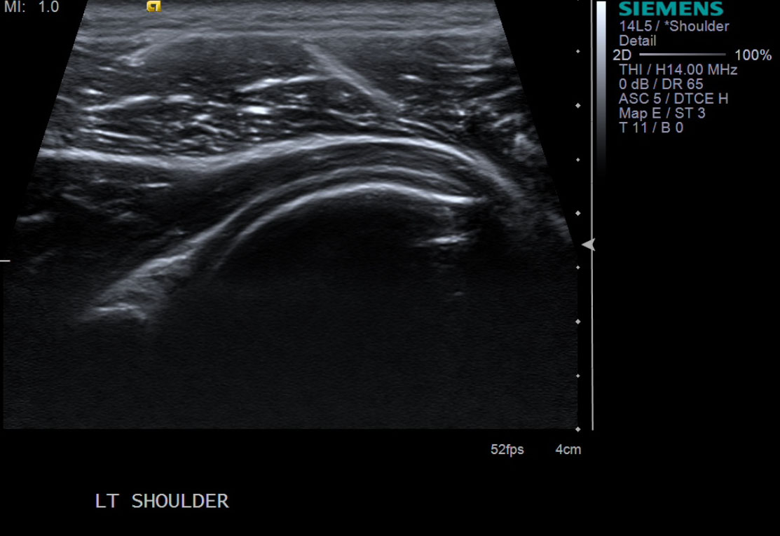 Shoulder Arthrogram Injection